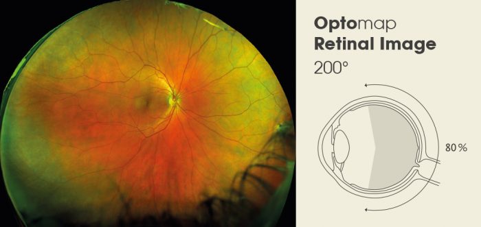 Optomap : Opula Opticians